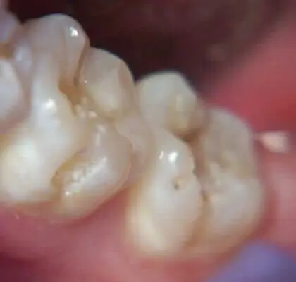 What is Invisalign? Invisalign vs Braces. Is it Worth the Cost?