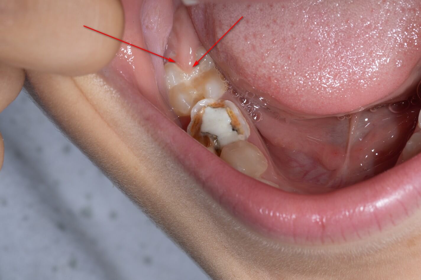 Pericoronitis Treatment